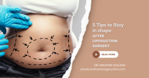 5 Tips To Stay In Shape After Your Liposuction Surgery - Plastic and ...